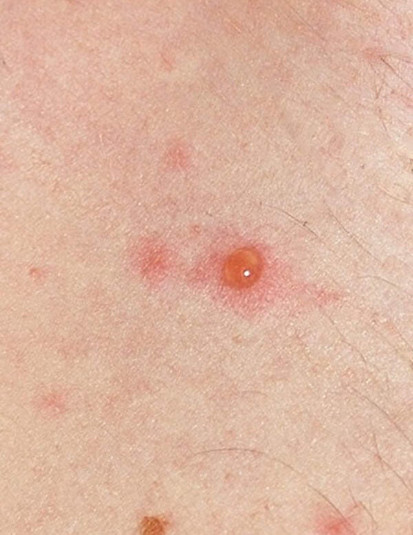 VariZIG (Varicella Zoster Immune Globulin Human) for the Treatment of ...