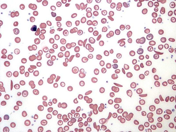 bluebird bio begins treatment in Phase I trial of BB305 to treat sickle ...