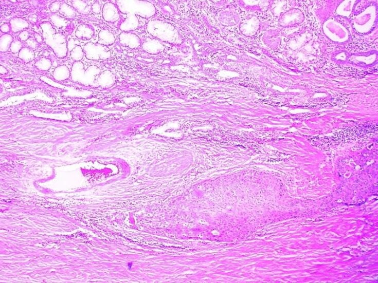NextCure begins Phase l/ll trial of NC318 for solid tumours
