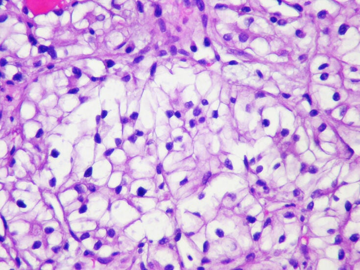 Merck’ Keytruda with Pfizer’s Inlyta improves survival in kidney cancer