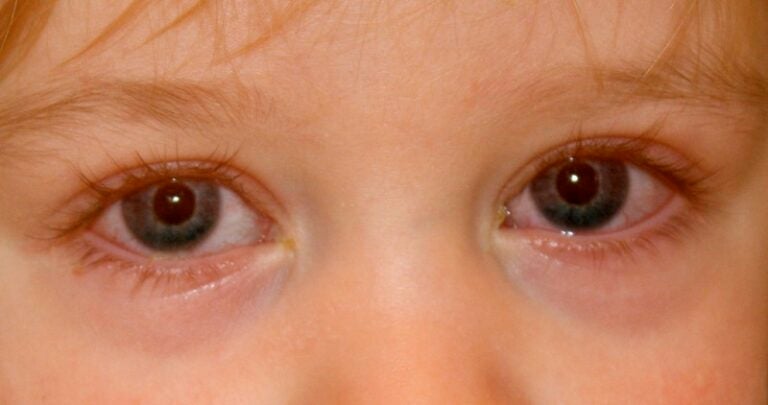 Okogen starts Phase ll trial of OKG-0301 for adenoviral conjunctivitis