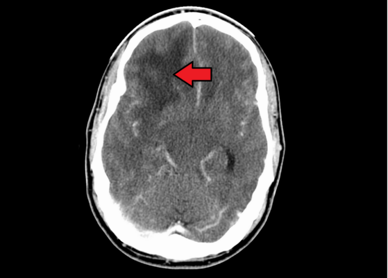 VBI Vaccines doses first recurrent GBM patient in trial of VBI-1901