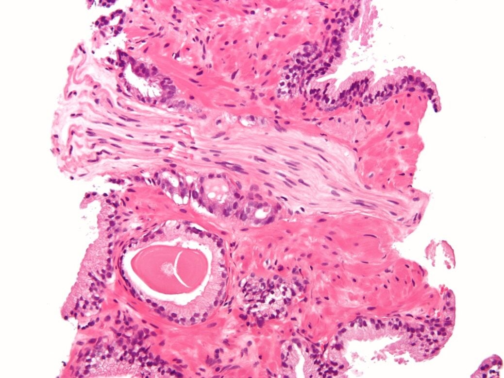 Forma doses first patient in Phase 1 prostate cancer treatment trial