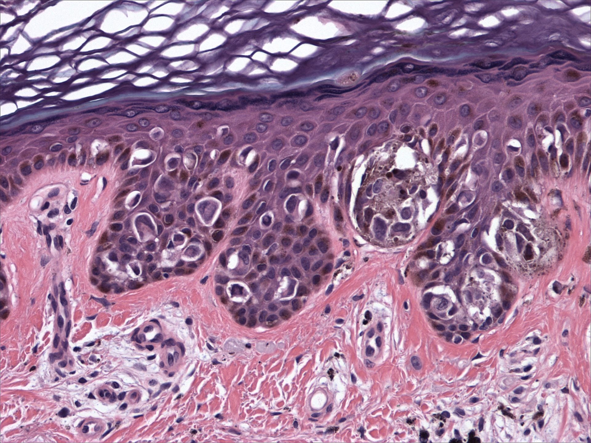 Merck’s Keytruda boosts recurrence-free survival in melanoma trial