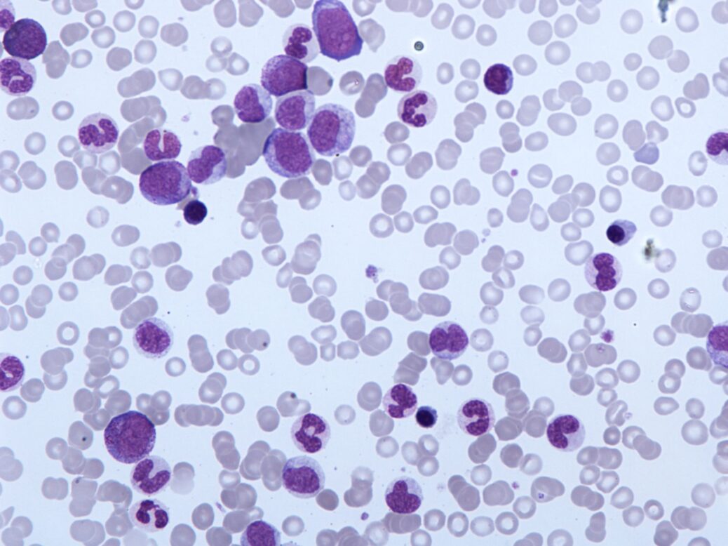 Astex Pharmaceuticals reports updated Phase III data of Inqovi for MDS