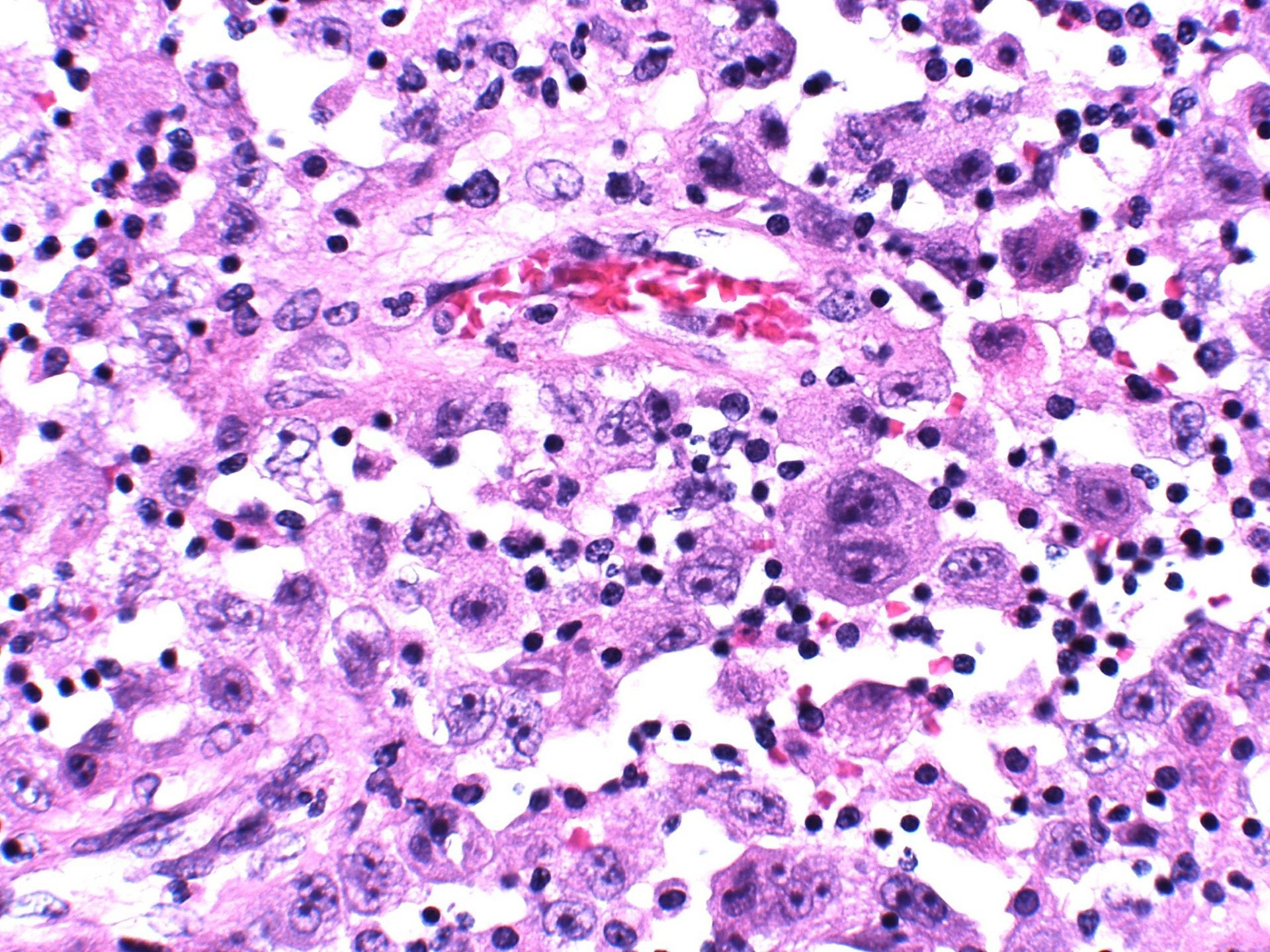 Amgen reports favourable data from Phase II trial of Lumakras for NSCLC