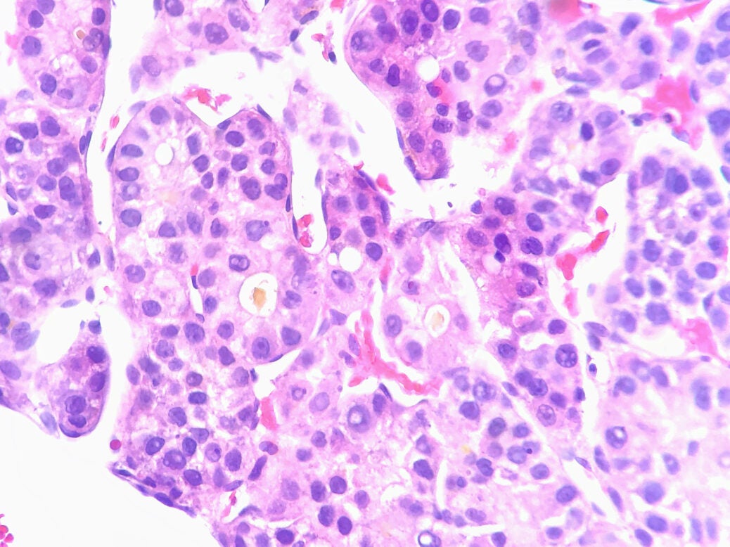 Merck’s Keytruda meets primary goal in Phase III liver cancer trial