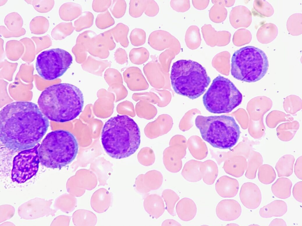 Apollomics doses first subject in Phase III AML therapy trial in China