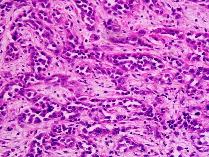 Bellerophon starts INOpulse treatment in coronavirus patients