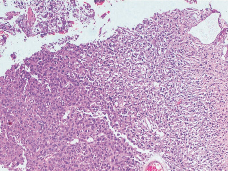 UroGen starts Phase III trial of non-surgical bladder cancer treatment