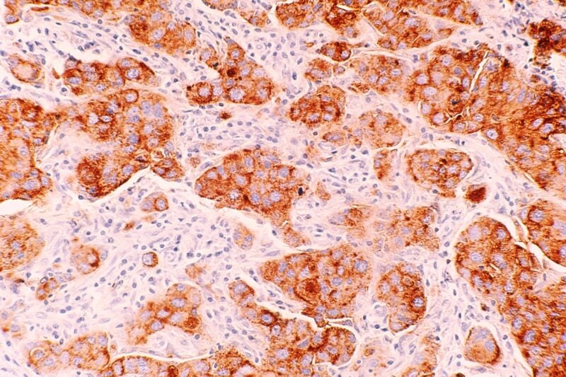 Synthekine doses first subject in Phase I trial of solid tumour therapy