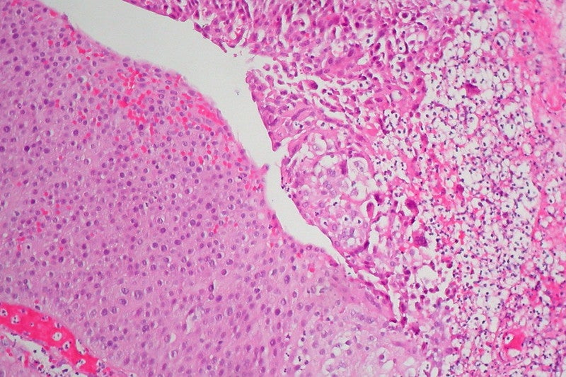 Jazz enrols first subject in Phase II trial of solid tumour monotherapy