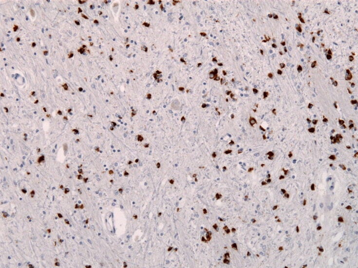 BMS’ deucravacitinib shows superiority in Phase III psoriasis trial