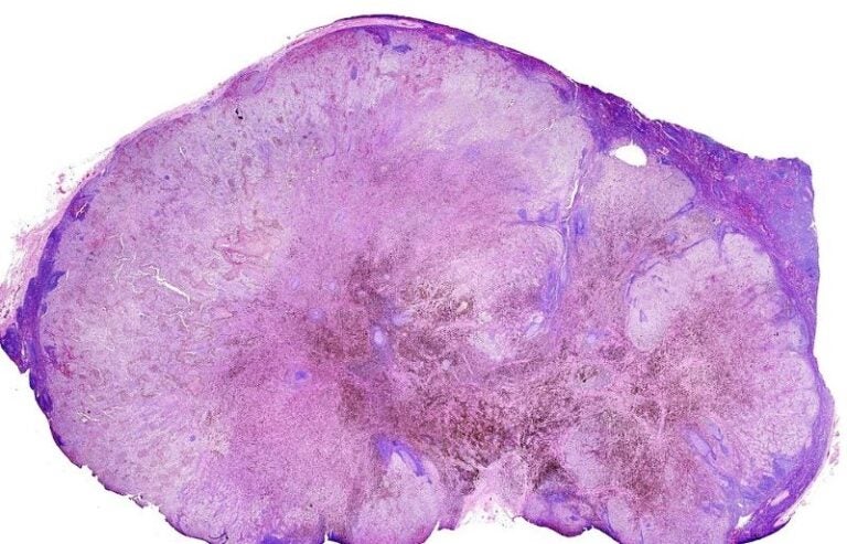 BMS’ deucravacitinib shows superiority in Phase III psoriasis trial