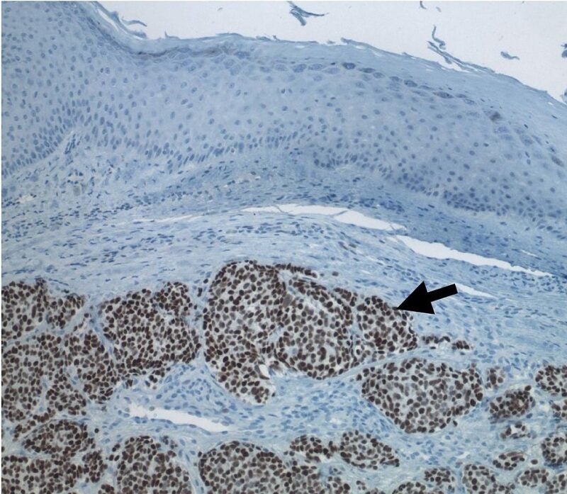 Immunomic doses first subject in Merkel cell carcinoma vaccine trial