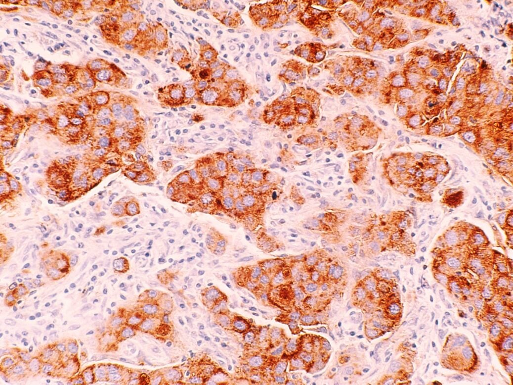 BMS’ deucravacitinib shows superiority in Phase III psoriasis trial