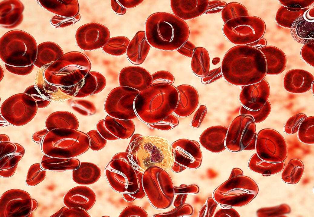 VONJO (pacritinib) for the Treatment of Myelofibrosis, USA