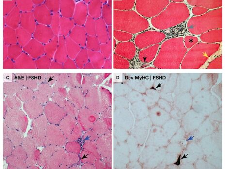 Avidity launches Phase I/II muscular dystrophy treatment trial
