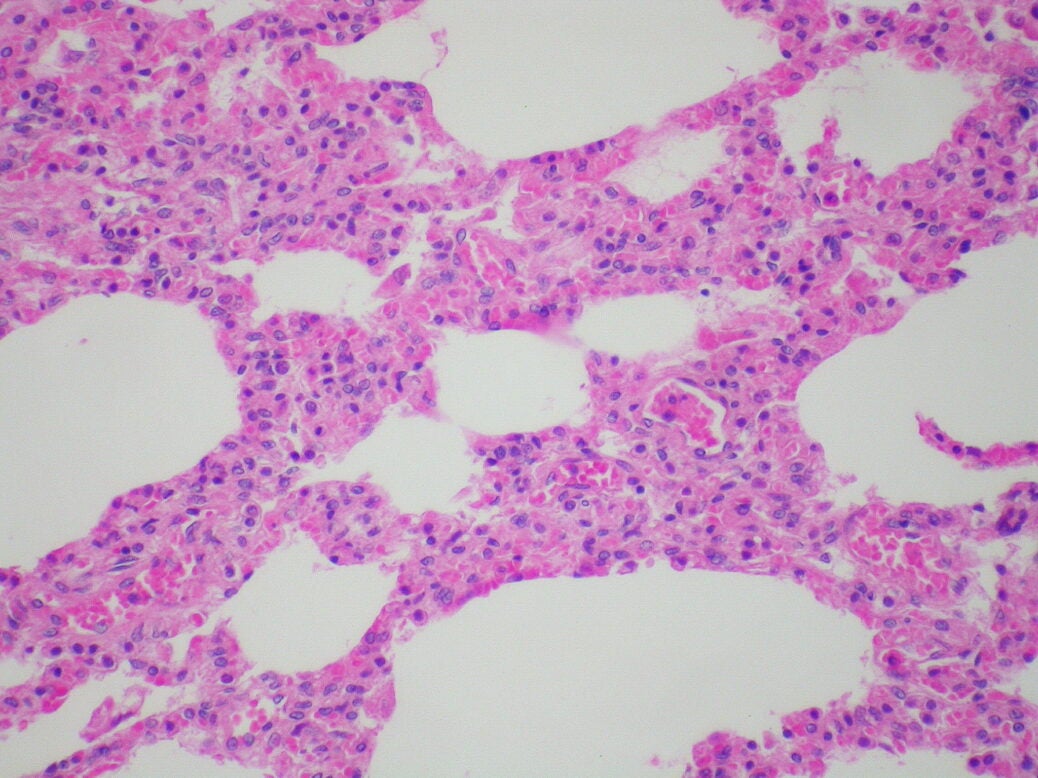 Enanta commences Phase IIb trial of RSV treatment