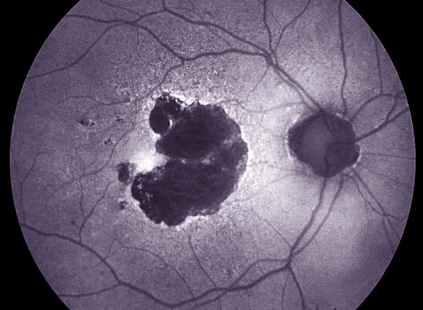 Minocycline for dry AMD treatment shows no benefit in NIH trial