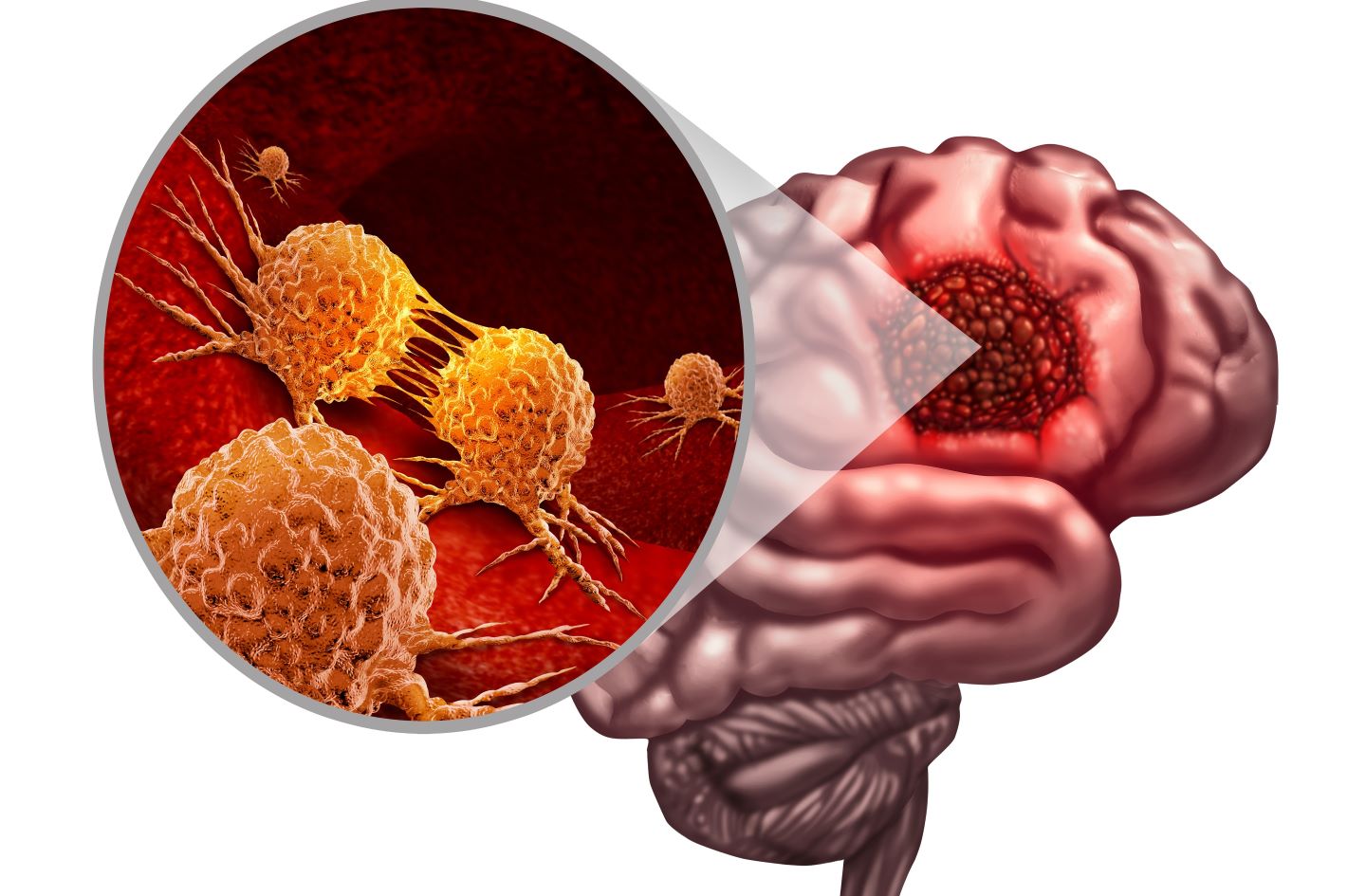 Imvax concludes enrolment in Phase IIb glioblastoma treatment trial