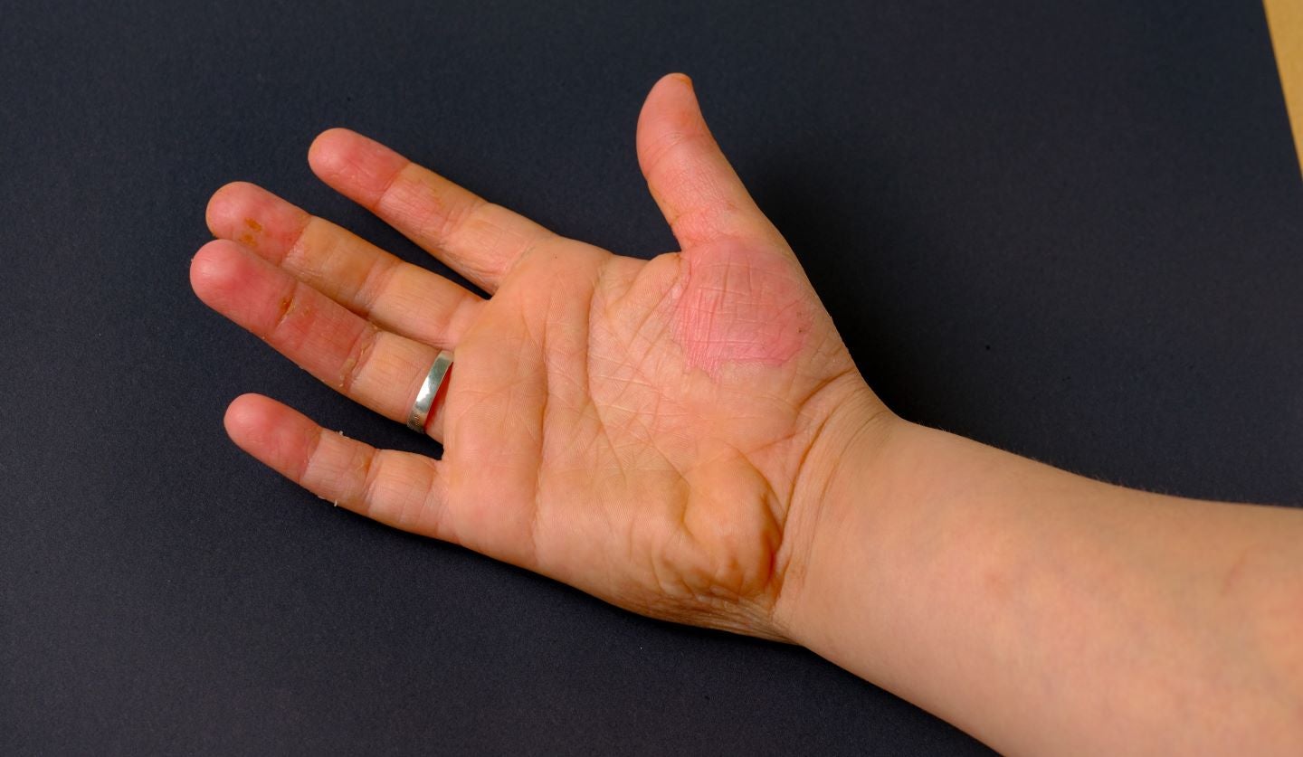 Priovant enrols all subjects in trial of dermatomyositis treatment