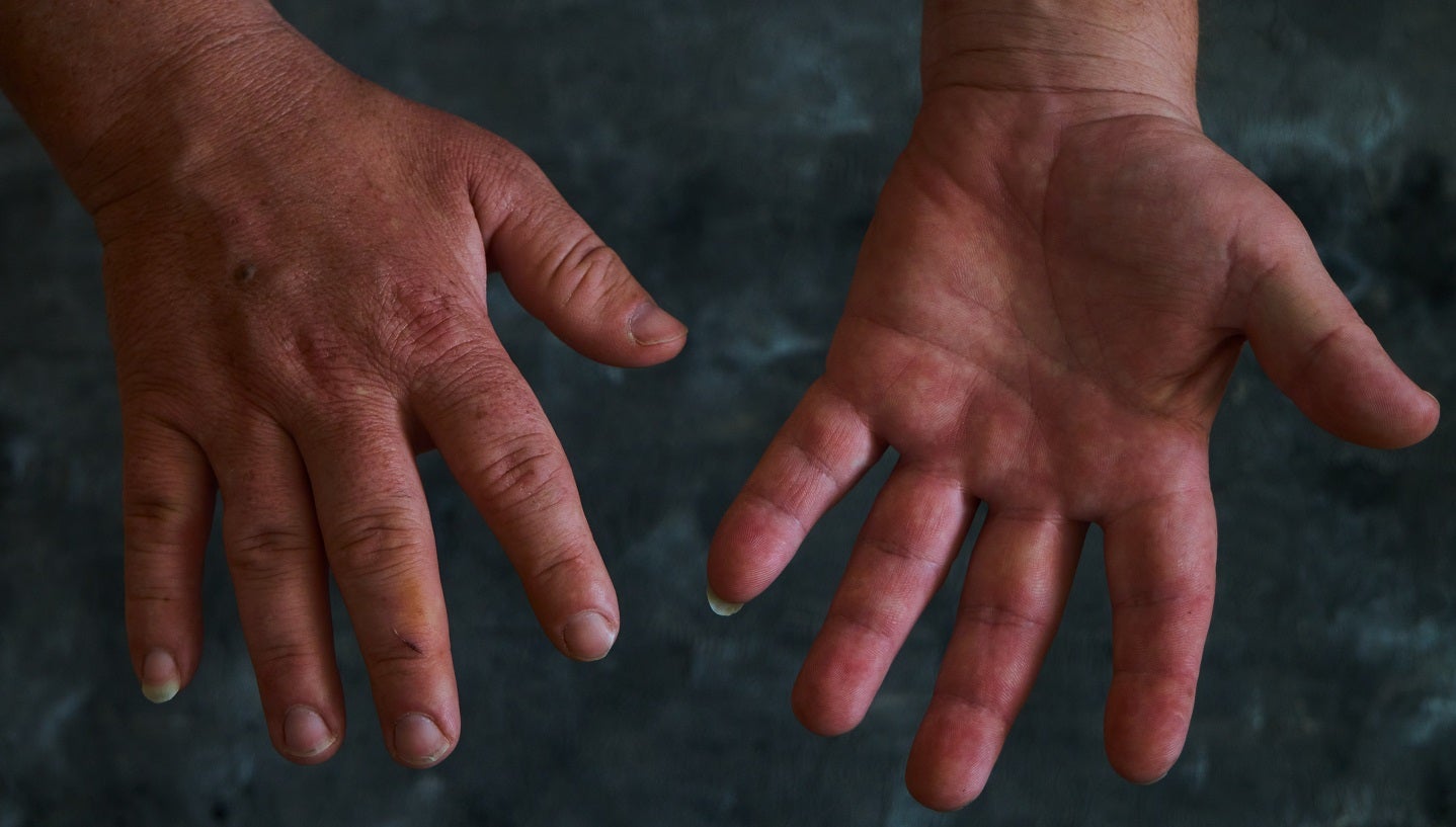 Camurus reports positive results from trial of acromegaly treatment