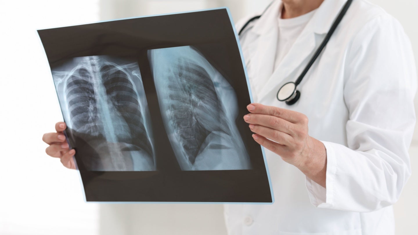 Endeavor doses first subject in Phase IIb trial of ENV-101 for IPF