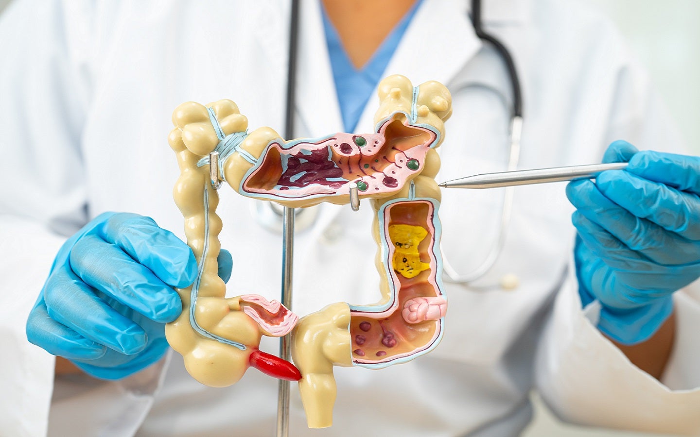 Palisade begins MAD cohorts of Phase Ia/b UC therapy trial